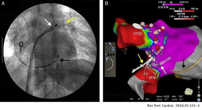 Electrophysiological Studies and Ablation - Dr Paul Heart Clinic